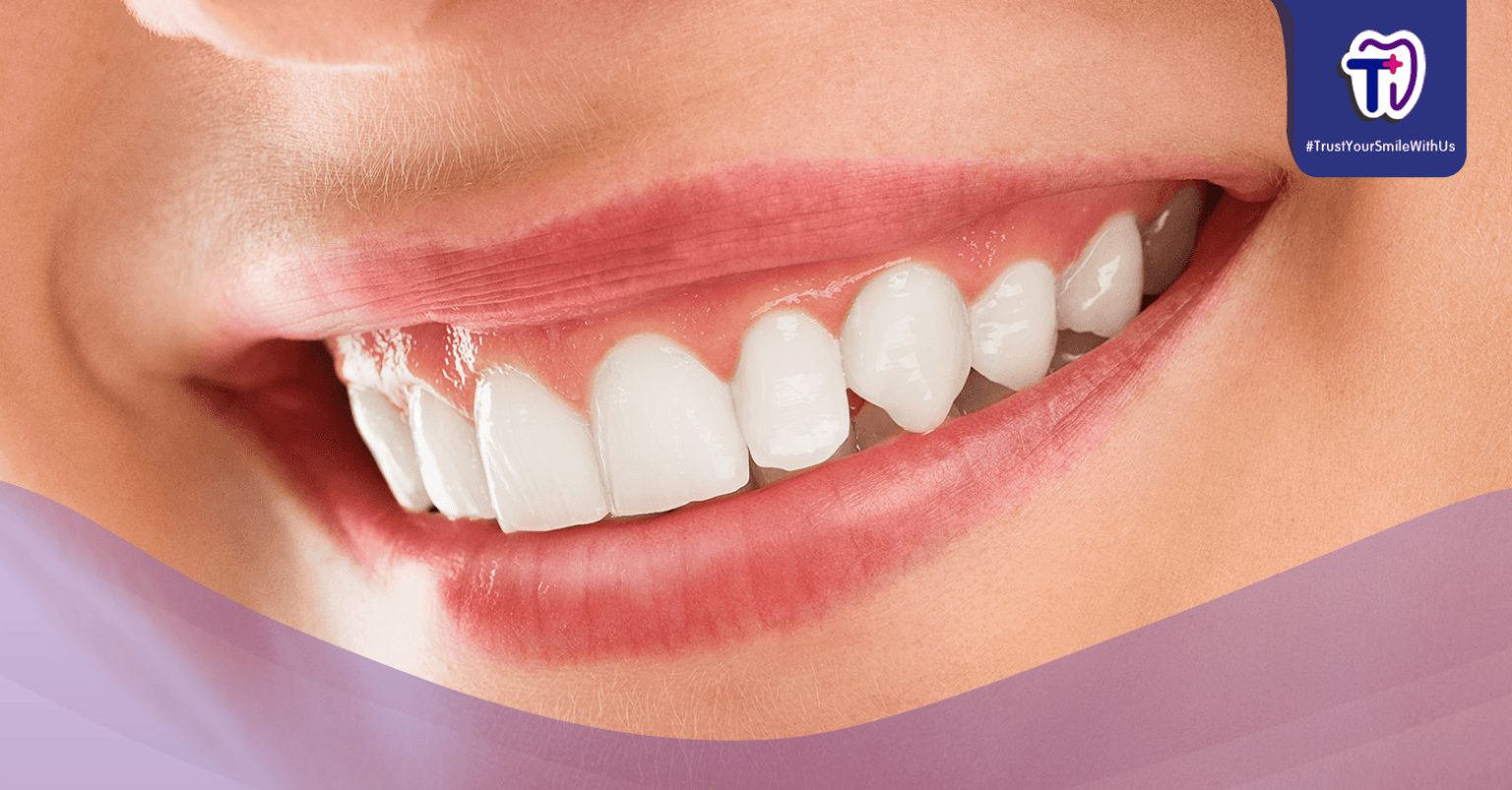 Veneer Gigi: Solusi Estetik untuk Gigi Rapi dan Putih