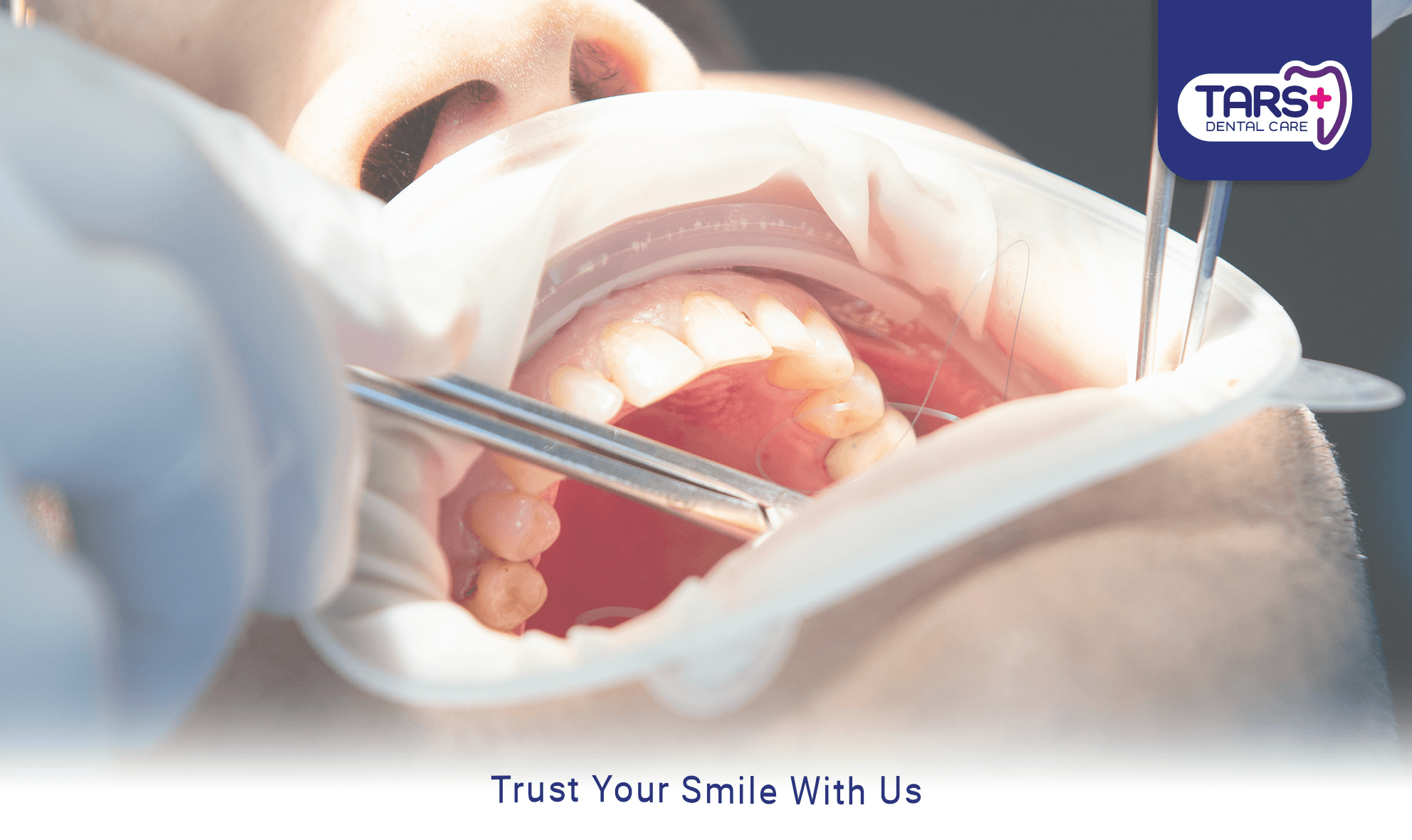 5 Fakta Penting tentang Cabut Gigi Saat Hamil: Tips dan Waktu Terbaik