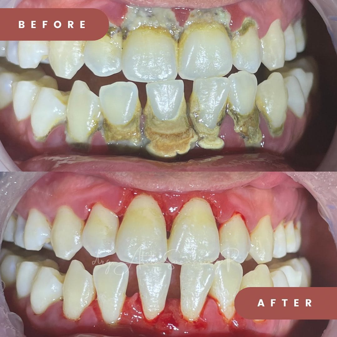 Stain dan Karang Gigi: Penyebab, Gejala, dan Perawatannya