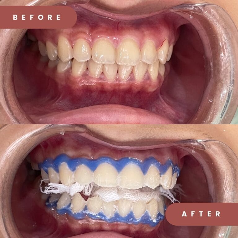 Ingin Gigi Putih Permanen? Ini Kelebihan & Kekurangan Bleaching dan ...