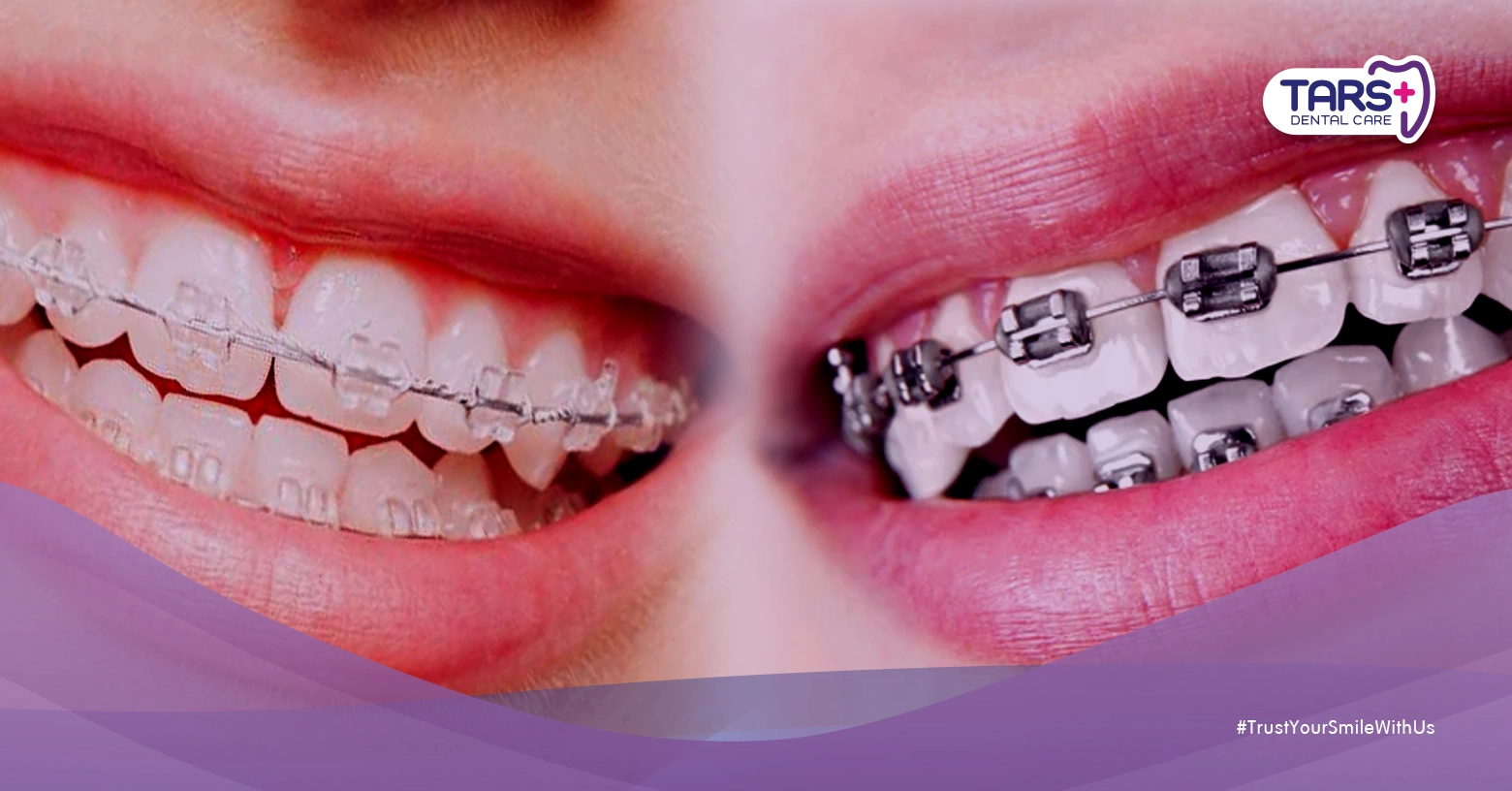 Perbandingan Lengkap Behel Transparan vs Behel Metal: Pilihan Terbaik ...