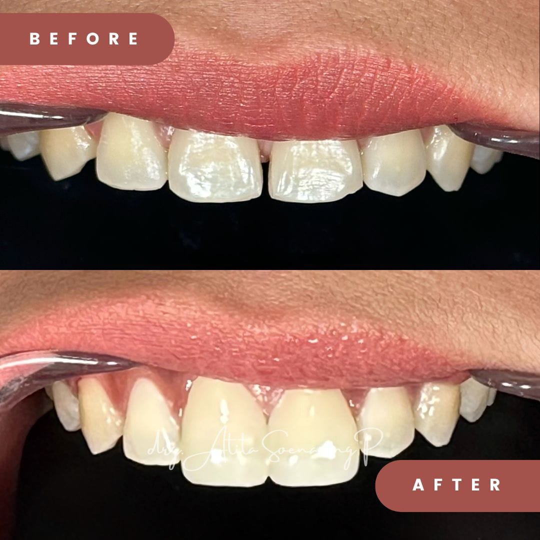 Bleaching dan Veneer: Biaya, Prosedur, Keunggulan, Kekurangan, dan ...