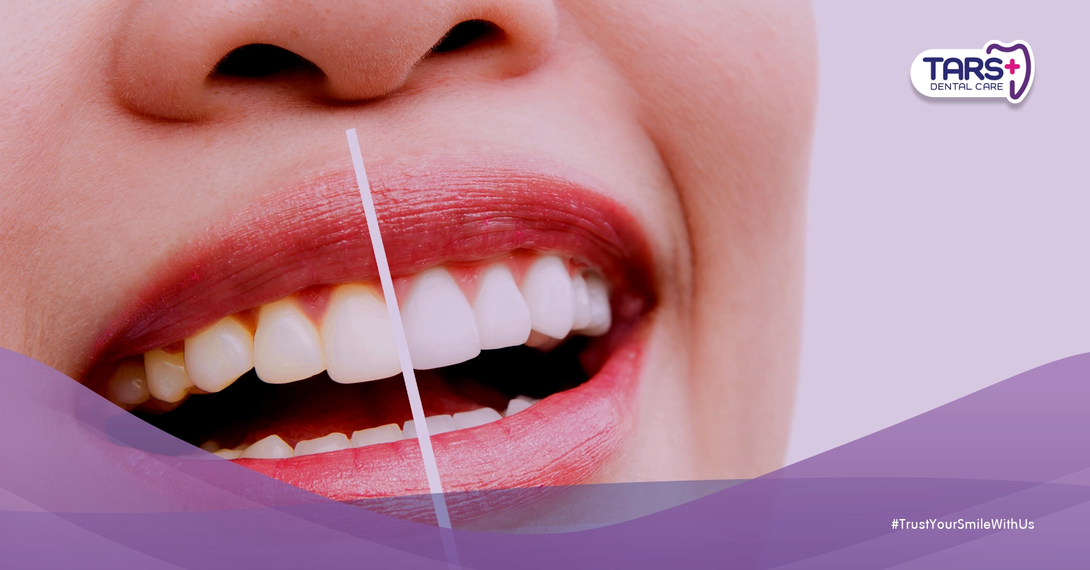 Gigi Kuning Padahal Sikat Gigi? Ini 5 Fakta Penting yang Harus Kamu Tahu