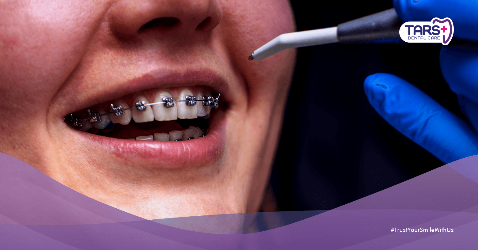 Gigi Dewasa Bisa Rapi Tanpa Behel? Ini 7 Fakta Mengejutkan